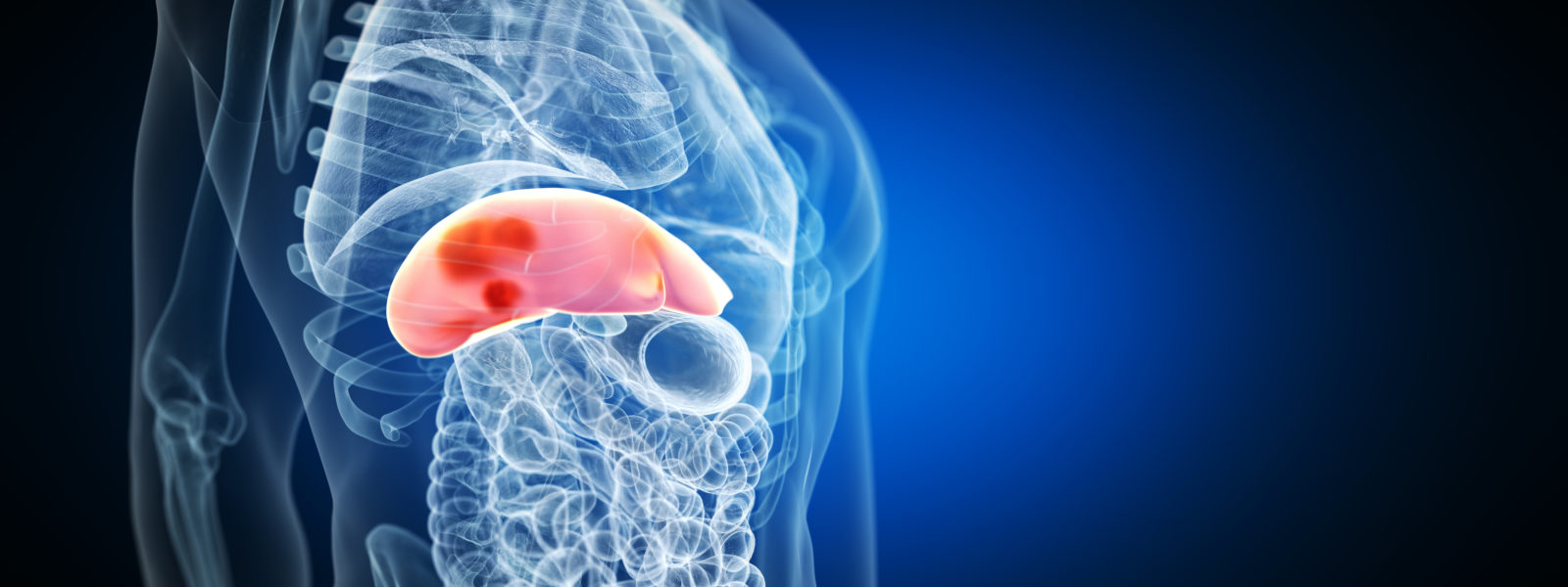 Burial Insurance With Cirrhosis Of The Liver and Liver Disease ...